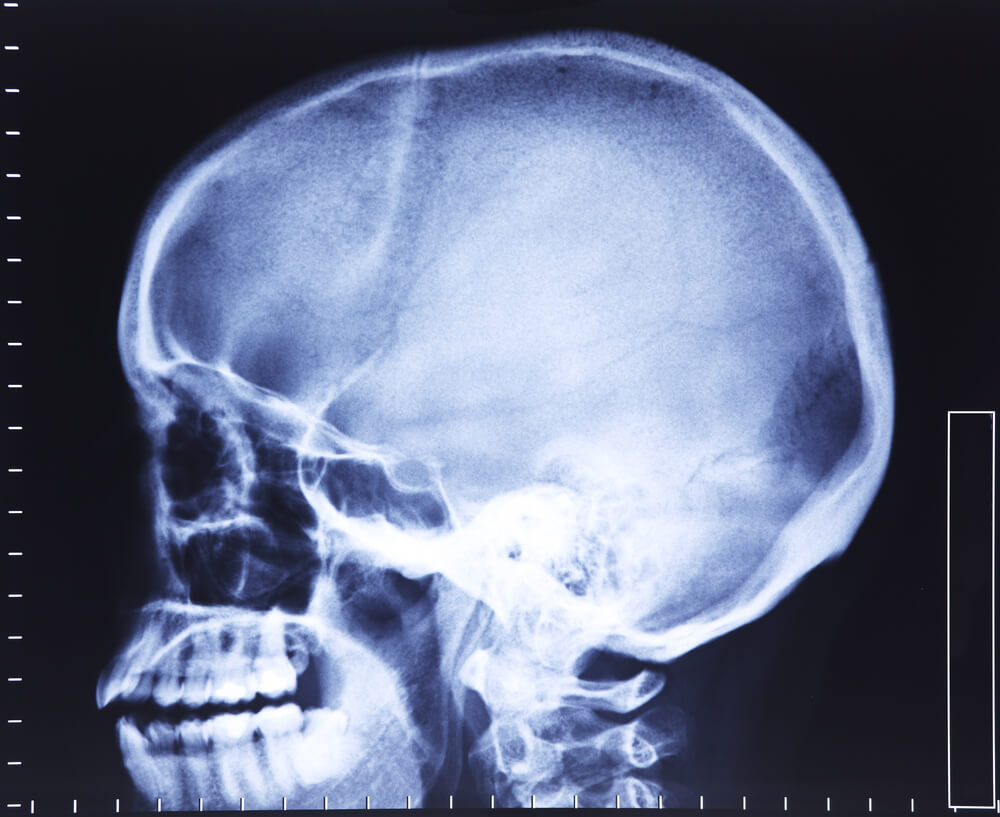 Cranial x-ray - Health Career Talent®